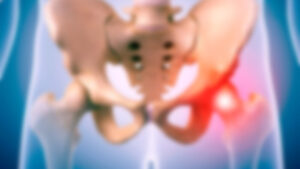 Girdlestone Surgery After a Failed Hip Replacement